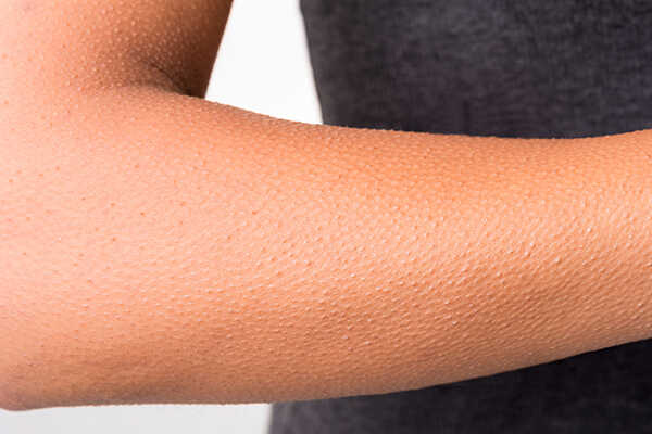 جلد الوزة .. ماهو ؟ وماأفضل العلاجات الفعالة للقضاء عليه